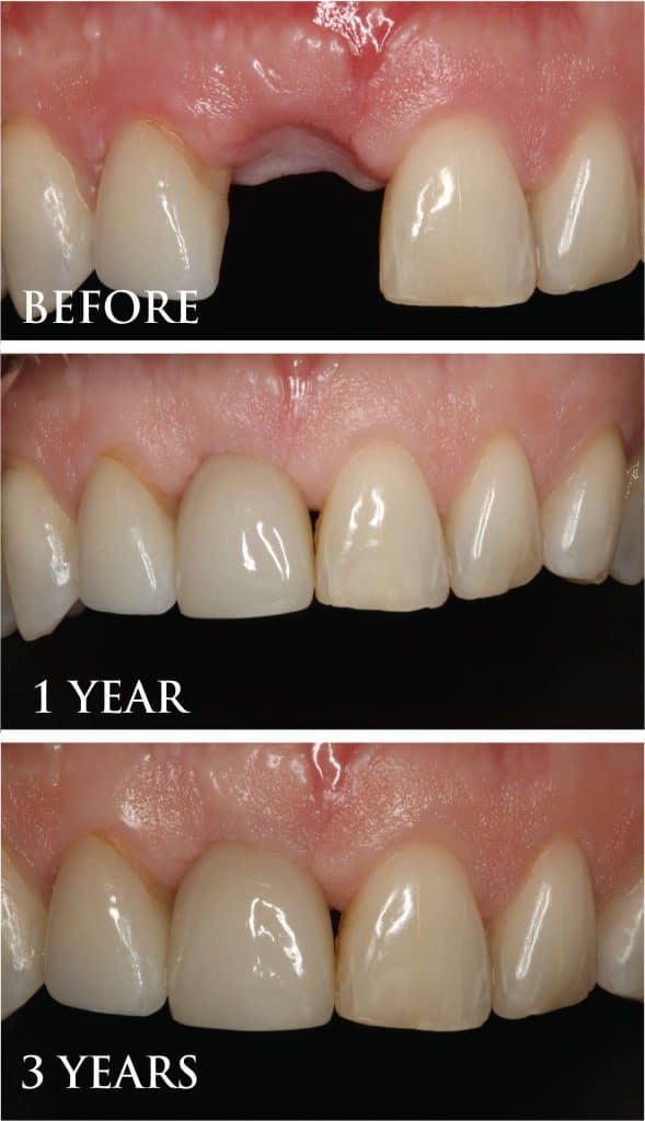 Smile Gallery | Before and After Periodontal Therapy
