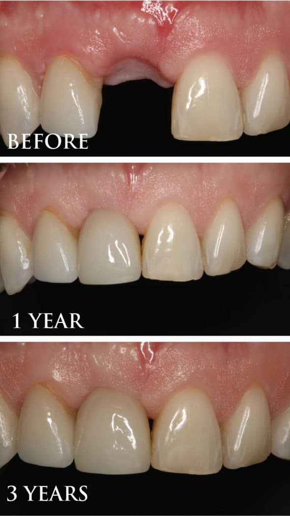 Smile Gallery | Before and After Periodontal Therapy