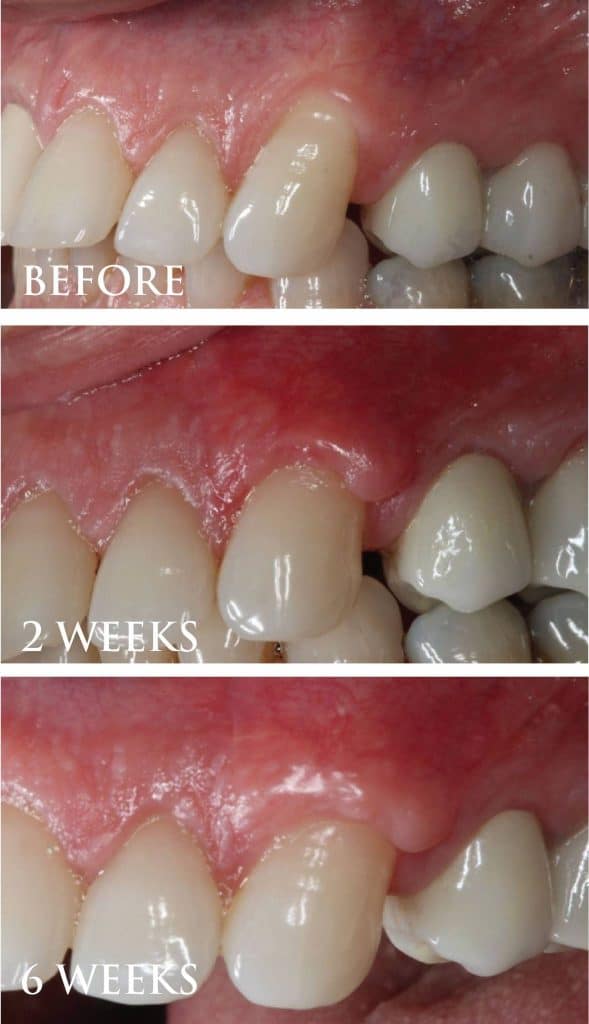 Smile Gallery | Before and After Periodontal Therapy